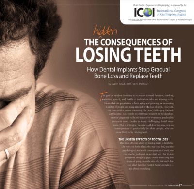 Dental Implants Canandaigua | Geneva | Victor NY
